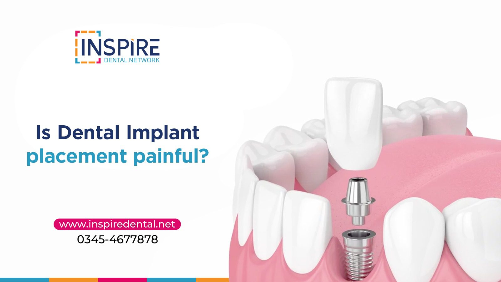 Is Dental Implant Placement Painful? What to Expect During and After ...